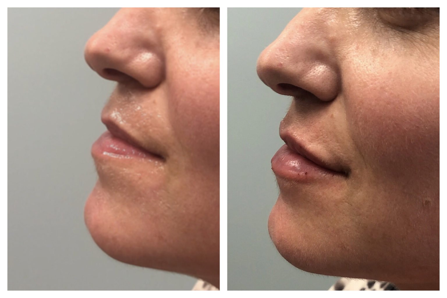 Kysse: New Kissable Filler Approved By FDA - Restore SD Plastic Surgery